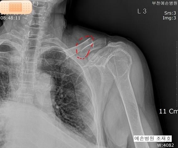 쇄골 골절빗장뼈 골절에서의 관혈적 정복 및 내고정술orif Of Clavicle Fracture 네이버 블로그