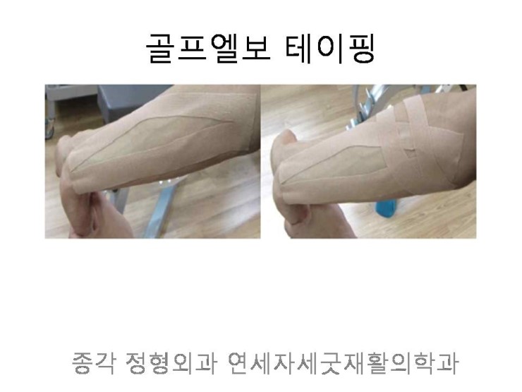 골프 엘보 테이핑 테니스 회전근개 종로 종각 정형외과 연세자세굿 네이버 블로그
