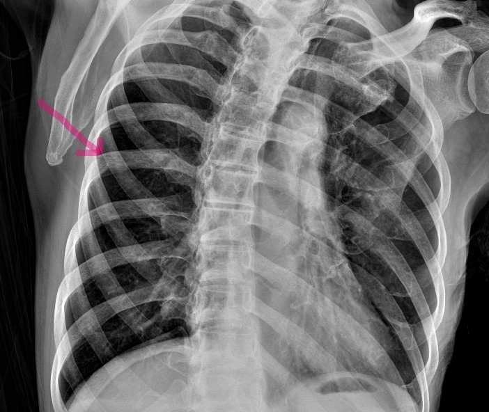 Rib fracture : 네이버 블로그