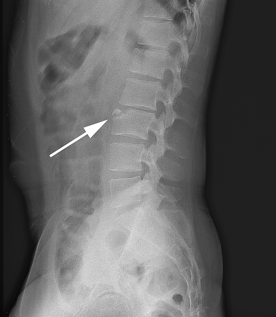 Limbus vertebra vs Fracture : 네이버 블로그