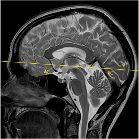 [MR,CT]Brain axial angle에 대한 고찰 : 네이버 블로그