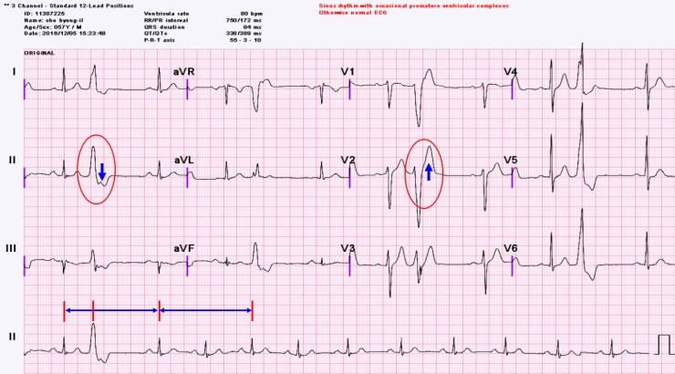 심전도 판독 : 리듬 III 조기박동, 기외수축 : 네이버 블로그