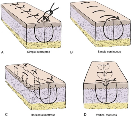 [의대생 실습] 봉합(suture); 의사 국시 실기시험 위주로 : 네이버 블로그