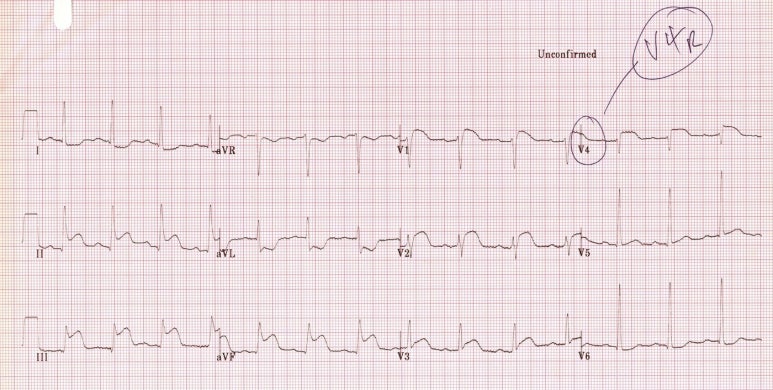 우심실 경색 (Right Ventricular infarction, RVI) : 네이버 블로그